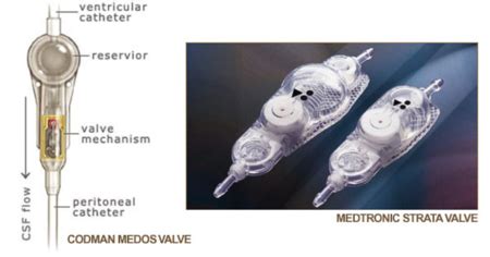 Ventriculoperitoneal Shunt Complications WikEM