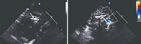 A Transthoracic Suprasternal Echocardiogram Showing Organized Download Scientific Diagram