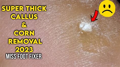 Super Thick Callous And Deep Corn Removal 2023 By Foot Specialist Miss