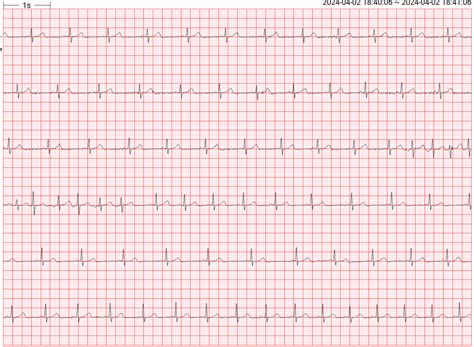 Short Svt Run With Weird Looking Qrss Why Do These Qrss Look Weird I Recently Saw A