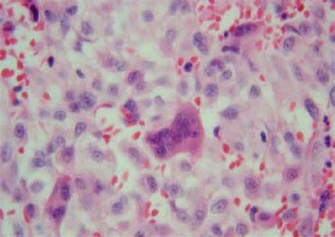 Figure 1 From Plexiform Fibrohistiocytic Tumor Of The Neck A Case