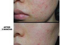 11 Before And After Ideas Copper Peptides Crepey Skin Peptide Serum