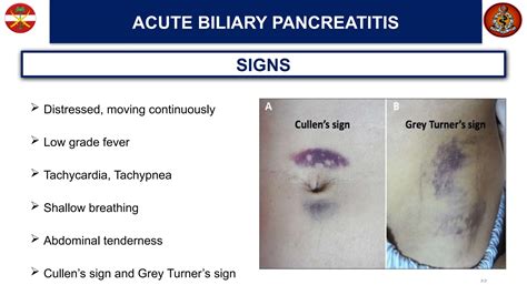 Symptoms Management To Investigation Of Acute Biliary Pancreatitispptx