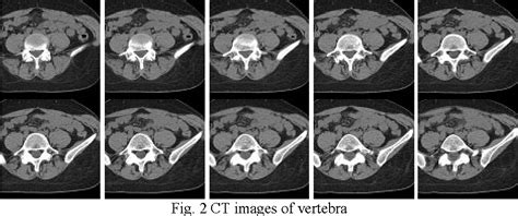 Figure 2 From Finite Element Modeling Of The Vertebra With Geometry And