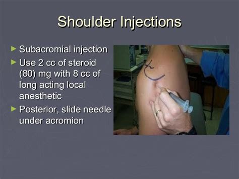 Posterior Subacromial Steroid Injection Download