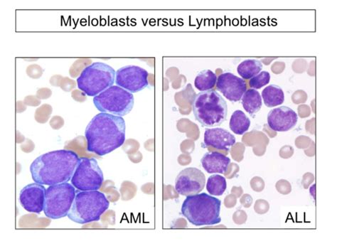 Uicom B2w7 Acute Leukemias Myelodysoplastic Syndrome Mds And