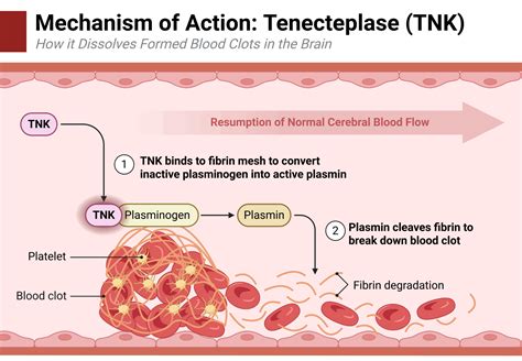 Breaking The Block Why Tenecteplase Is A New Contender In Ischemic Stroke Therapy Medracunc