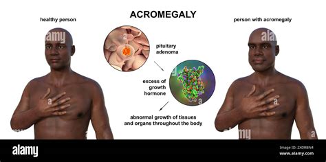 Acromegaly Face Figure 1 From Pachydermoperiostosis Vs Acromegaly In