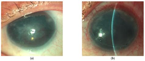 Superficial Keratectomy Alone Versus In Combination With Amniotic
