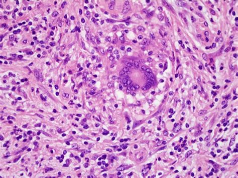 Pathology Outlines Nonspecific Granulomatous Prostatitis