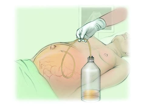 English For Nurses Mastering Ascites Drainage Paracentesis