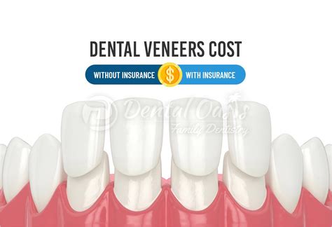 Veneers Cost Withwithout Insurance And Factors That Affects Cost