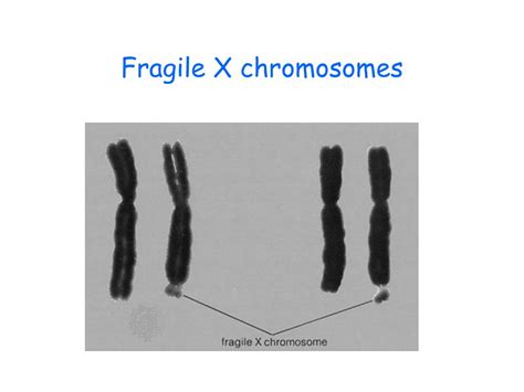 Ppt Fragile X Syndrome Powerpoint Presentation Free Download Id1138412