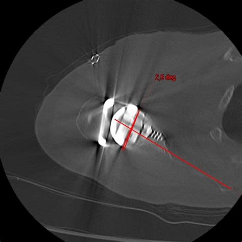 Postoperative Glenoid Retroversion Download Scientific Diagram