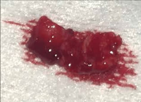 Connective Tissue Graft Download Scientific Diagram