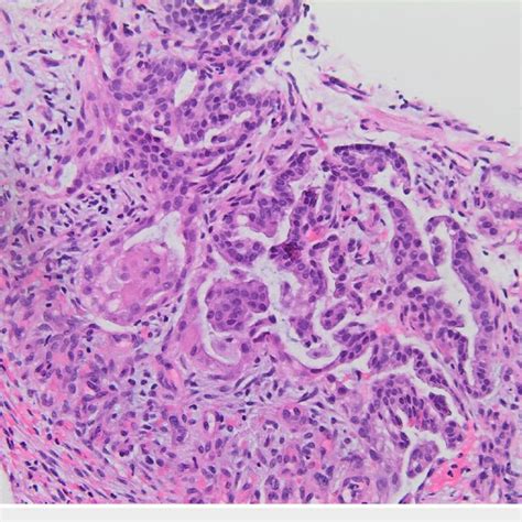 Examination Of The Lung Biopsy The Lung Biopsy Revealed A Tumor