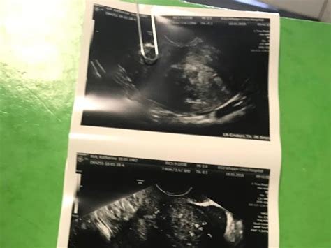How Do I Know If I Am Having A Miscarriage Counting To Ten
