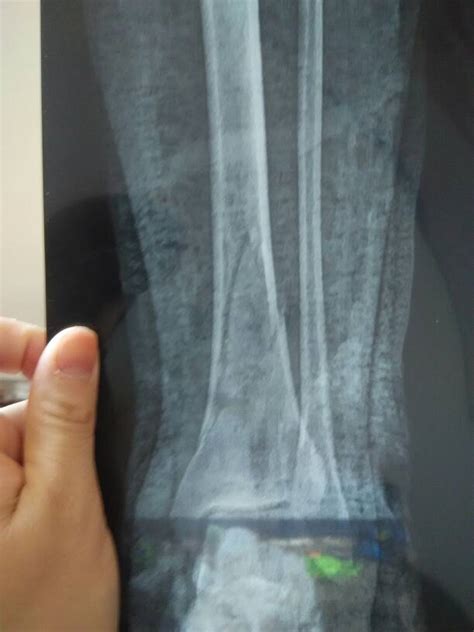 大腿骨折片子 大腿骨折片子图 伤感说说吧