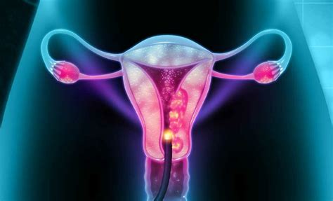 Intraepithelial Tumor Infiltrating Lymphocytes Shape Loco Regional Pet