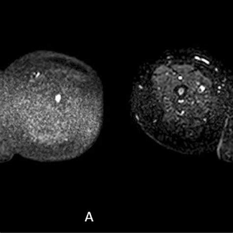 There Is No Diffusion Restriction On Dwi A And Adc B Images Download Scientific Diagram