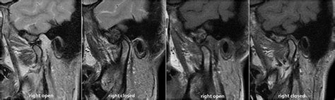 顎関節症mri 顎関節 Mri 診断方法 Hrurvm
