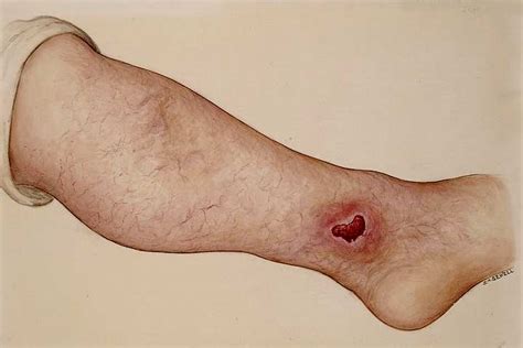 Leg Ulcer