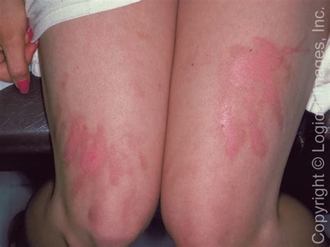 No Lime No Lesions Obalesque