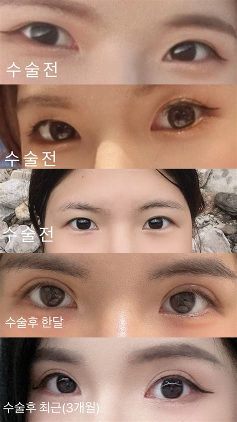 자유수다 6년전 부분절개 쌍 강남언니 1등 성형수술and피부시술 정보앱