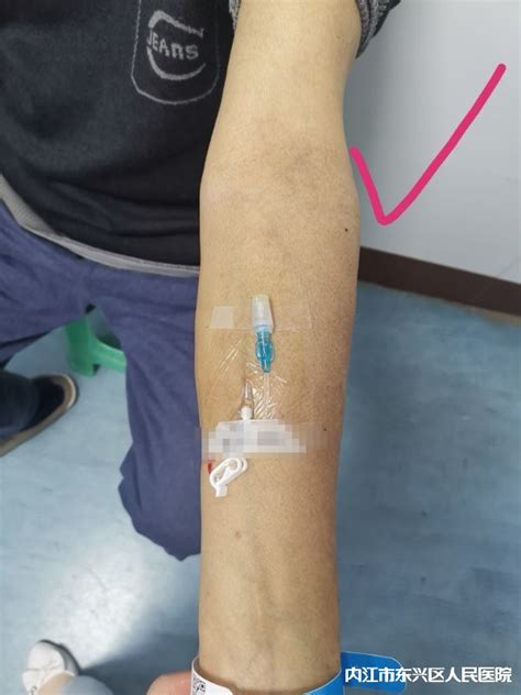 肘正中静脉穿刺 肘正中静脉 肘正中静脉位置 大山谷图库