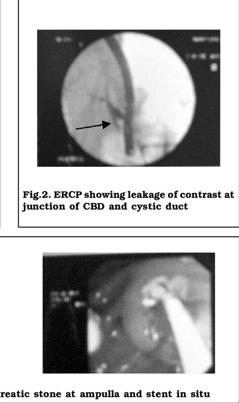 Mrcp Showing A Dilated And Irregular Pancreatic Duct With Intra Ductal Download Scientific