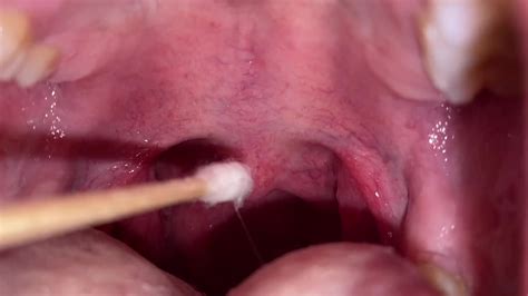 Touching Uvula