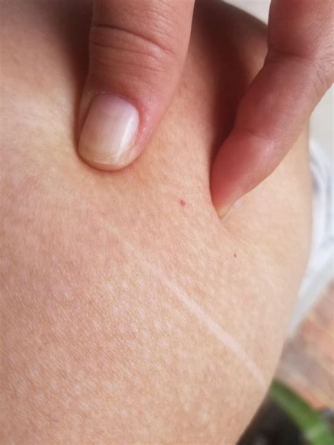Scleroderma Skin Rash