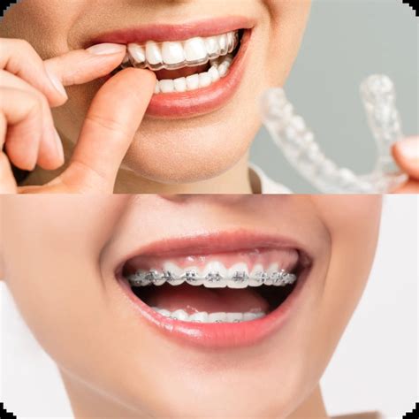 Clear Aligners Central Dental Elsternwick