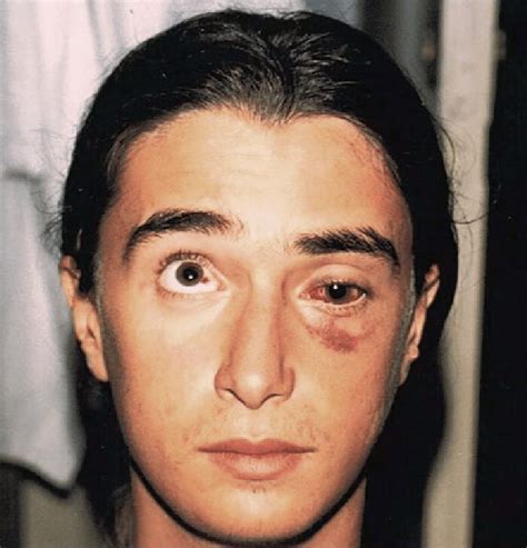 28 Vertical Diplopia Left Left Eye Does Not Follow The Download Scientific Diagram