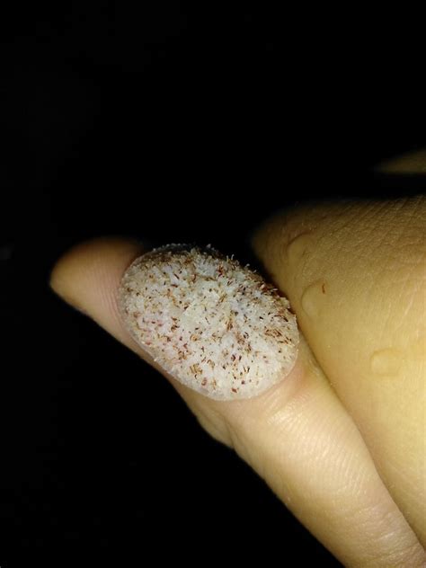 [cross Post] Filiform Wart R Trypophobia