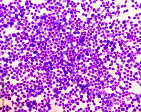 Synovial Fluid Cytology Plenty Wbc Microscopic Examination Of