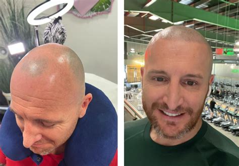 Gallery North West Scalp Clinic