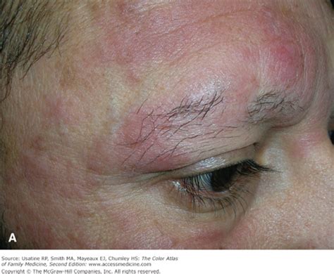 Cutaneous T Cell Lymphoma Basicmedical Key