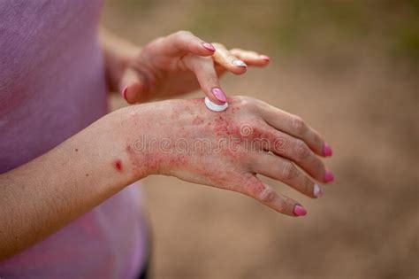 Eczema On The Hands The Woman Applying The Ointment Creams In The