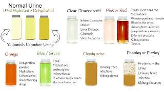 Bladder Infection Urine Color Urine Infections Urine Color What