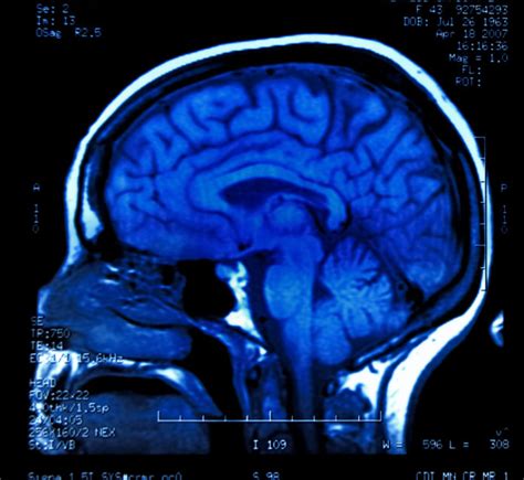 New Portable Mri Has High Brain Abnormality Detection Rate Radrounds Radiology Network