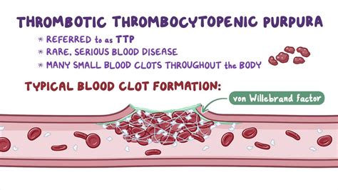 Video Thrombotic Thrombocytopenic Purpura
