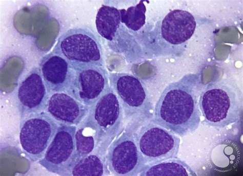 Diffuse Bone Marrow Metastasis Of Breast Cancer 2