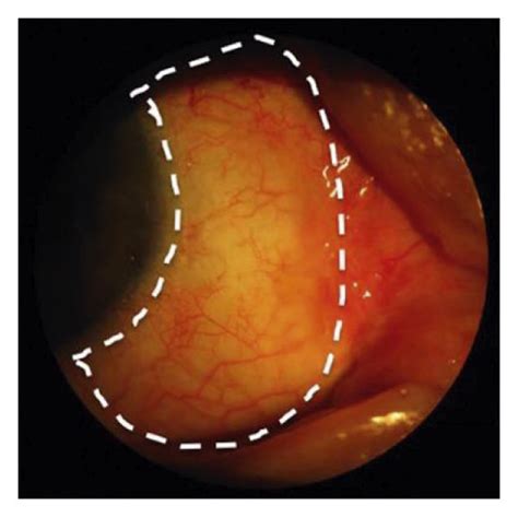 Conjunctival Manifestations Before During And After The Operation Download Scientific