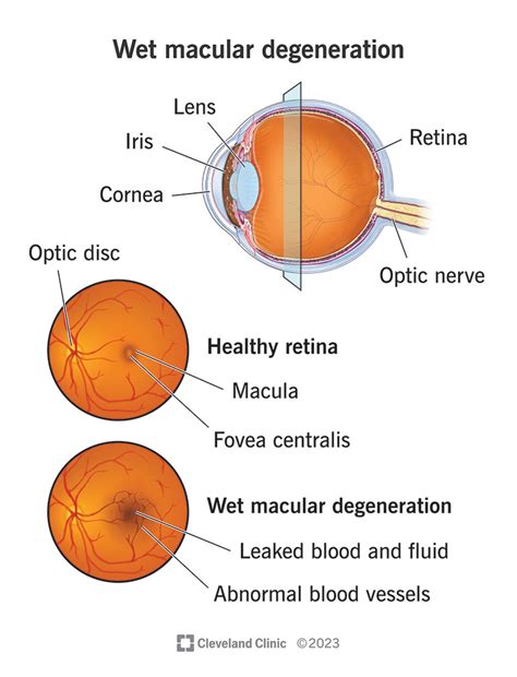 Wet Macular Degeneration Symptoms And Treatment
