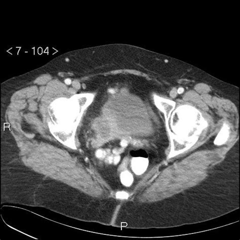 Pdf Post Menopausal Vaginal Bleeding Caused By Carcinoma Of The Appendix A Case Report