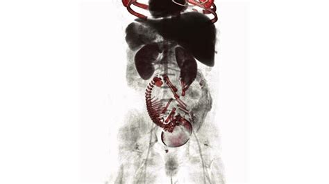 25 3d Reconstruction Ct Scan Stock Videos Footage And 4k Video Clips