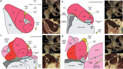 Figure 1 From Pericapsular Nerve Group Block And Iliopsoas Plane Block A Scoping Review Of