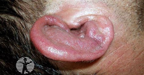 Relapsing Polychondritis Image