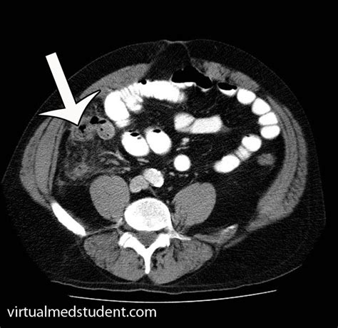 Appendix Ct Scan